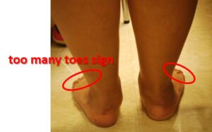 扁平足の評価とアプローチおススメ3選 | 理学療法士 山田ブログ